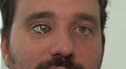Man Sees With Bionic Eye