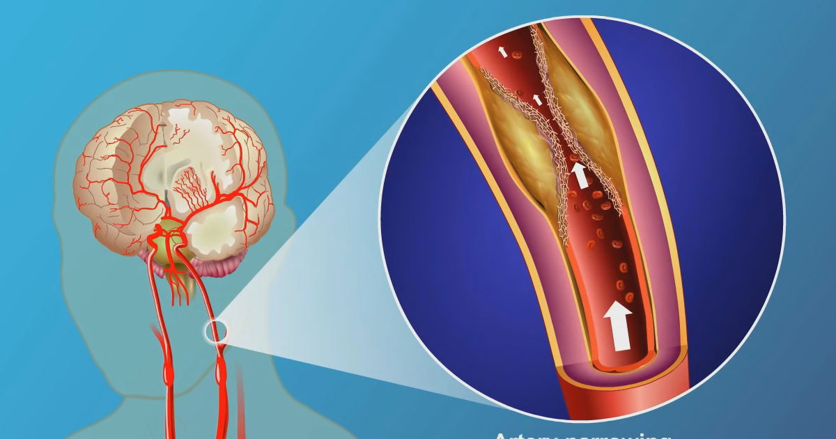 Understanding Stroke